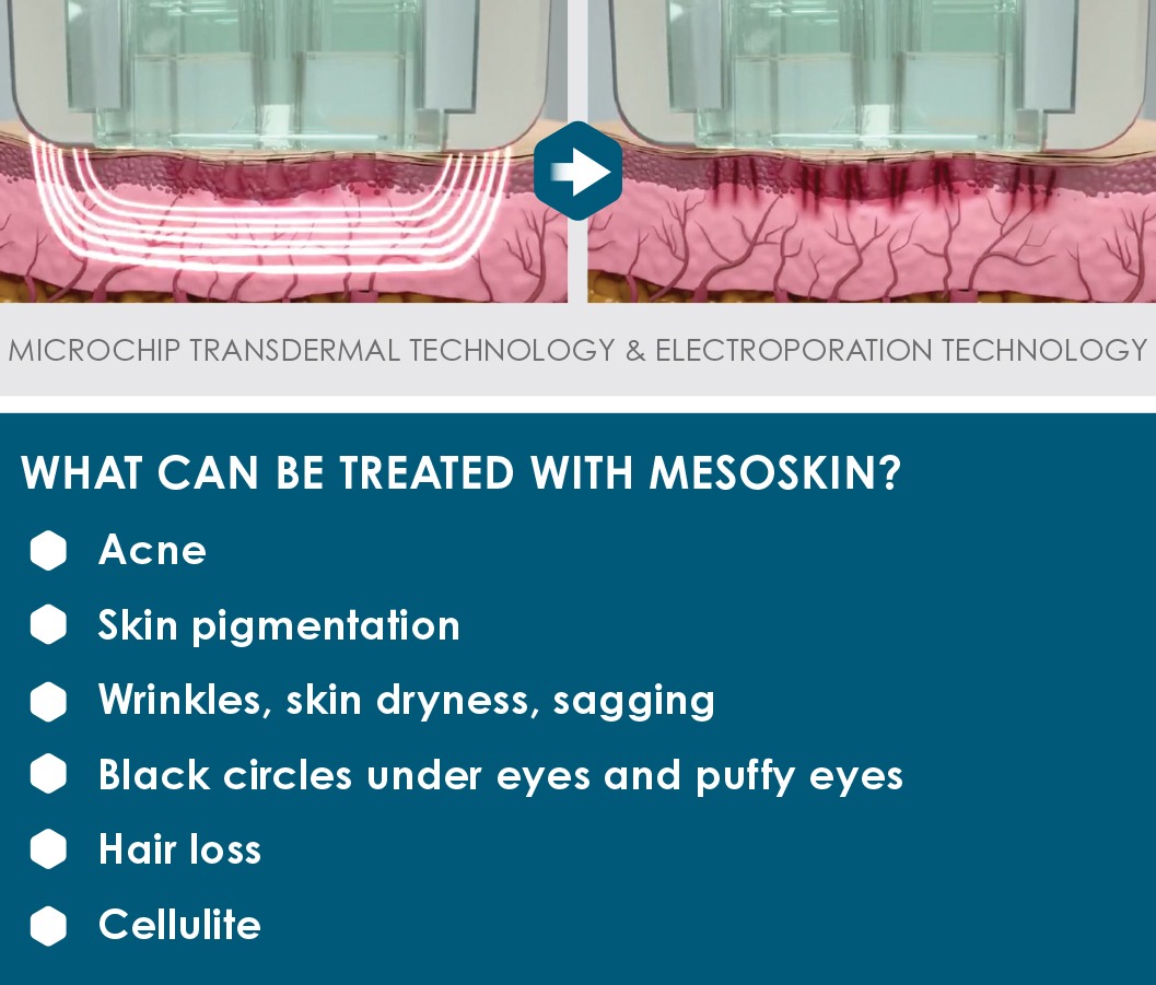 Essel Products: Mesoskin – The Latest Virtual Mesotherapy Solution ...