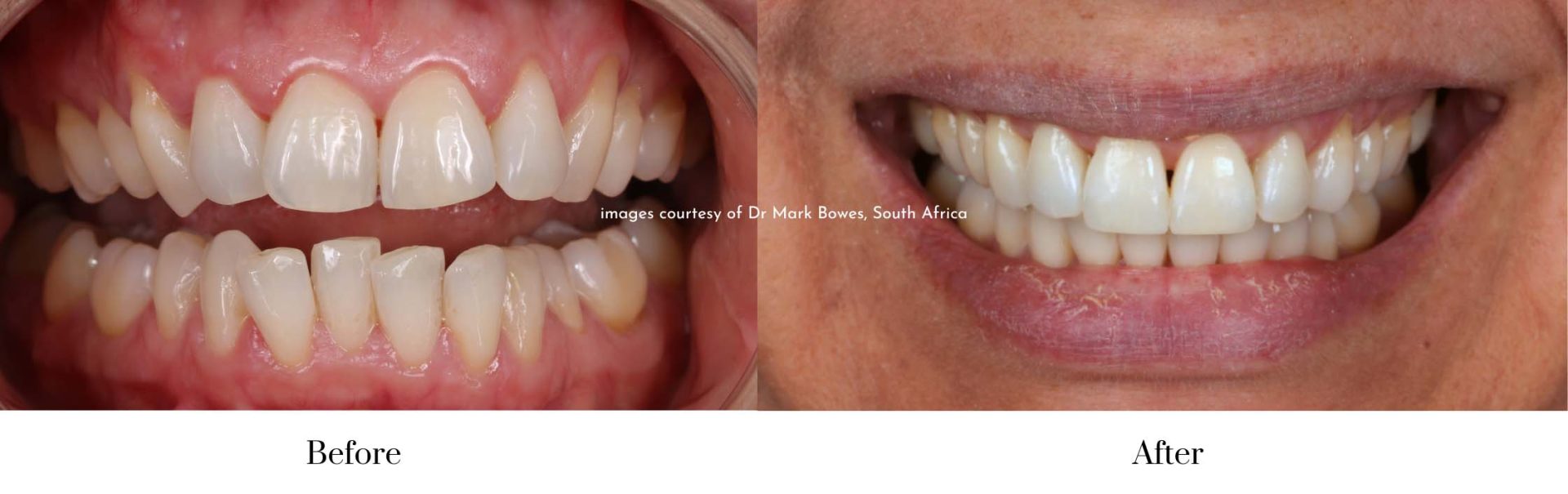 A Smile Transformation Is More Accessible Than You Think With ...