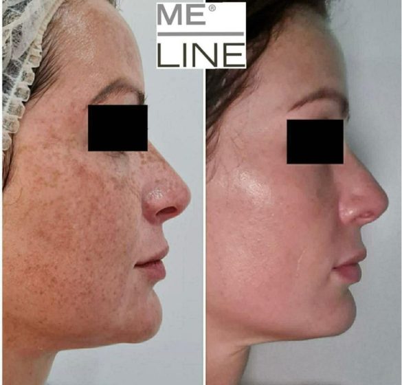 Achieve Radiant Skin With The MeLine® Treatment At Aesthetica Skin ...