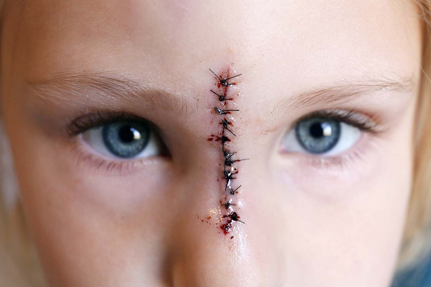 Toddler Scars: A Parent's Guide To Childhood Scarring | Aesthetic ...