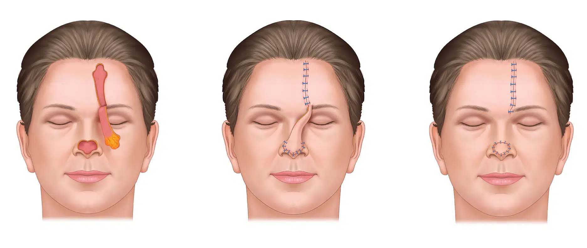Understanding Facial Reconstruction After Skin Cancer Surgery