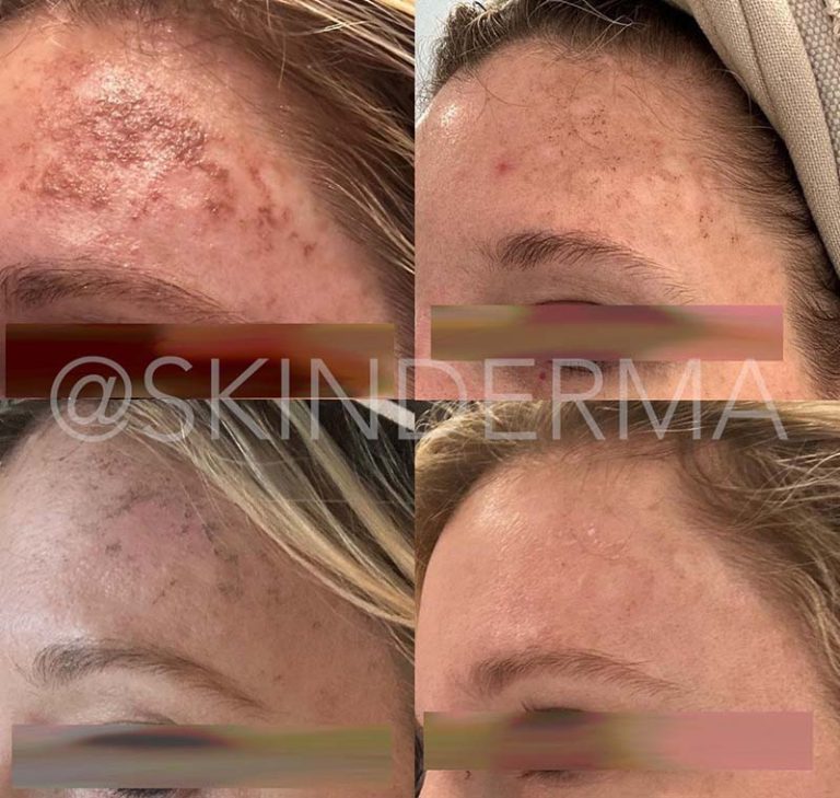 The Skinderma Melano Peel: A Hyperpigmentation Treatment Solution ...