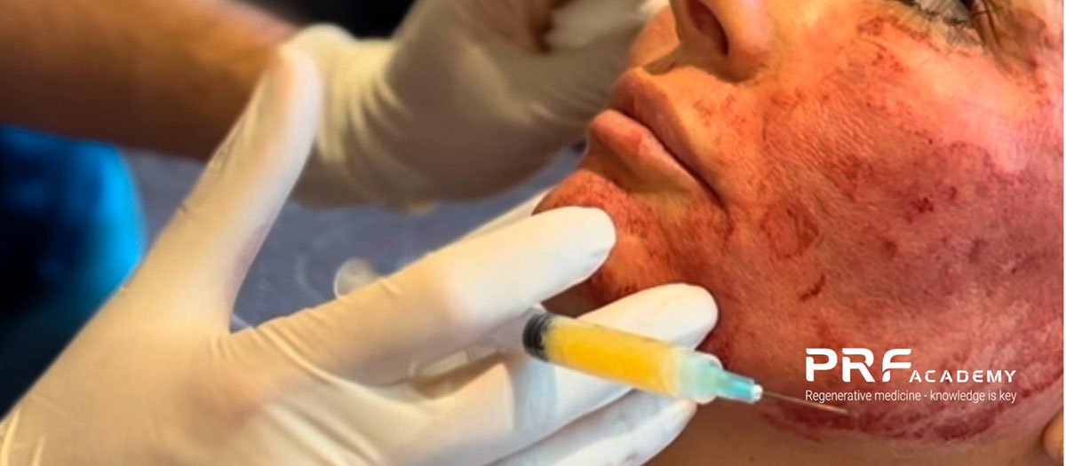 PRF In Facial Aesthetics Course: Mastering Innovation In Regenerative ...